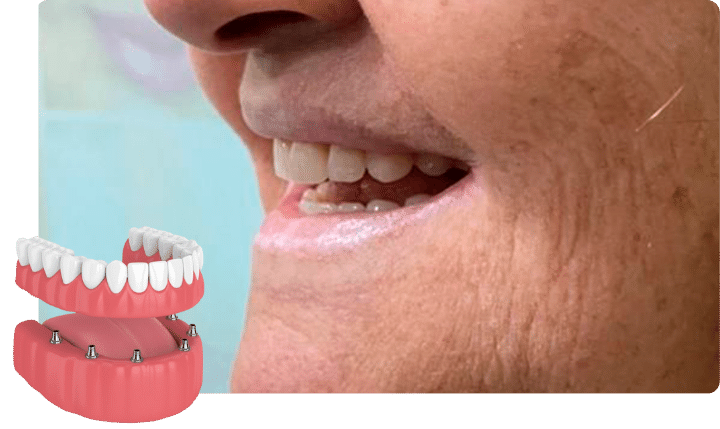 Prótese Fixa – Salgueiro Center